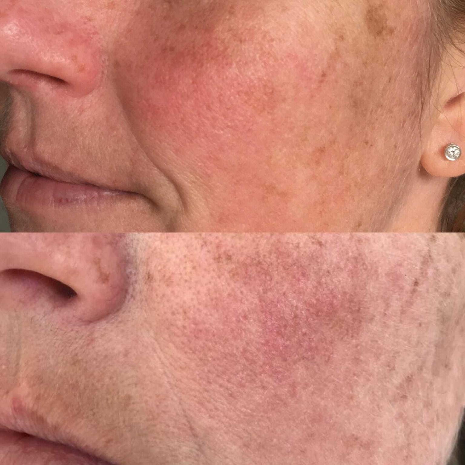 Rosacea blogs: Help reduce redness, heal your skin the right way!